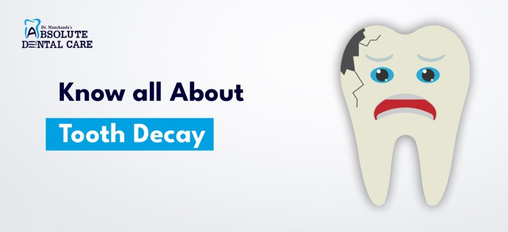 Know all about Tooth Decay – Absolute Dental Care Know all about Tooth Decay – Absolute Dental Care