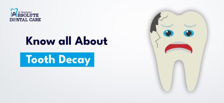 Know all about Tooth Decay – Absolute Dental Care